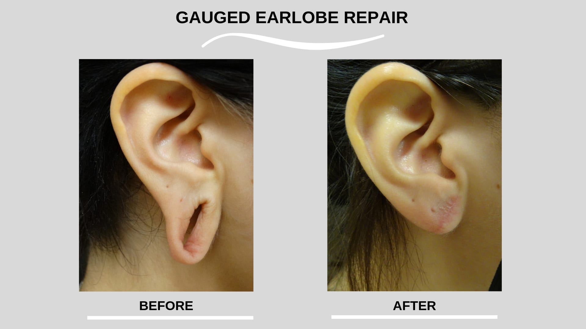 Ripped Ear Stretching Ripped Ear Stretching
