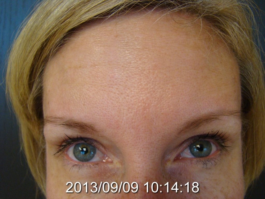 Botox Makes You Look Better... - Blogs by Ronald M. Friedman, M.D.